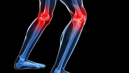 Kniearthrose (Gonarthrose) » Symptome, Ursachen & Therapie | MeinMed.at