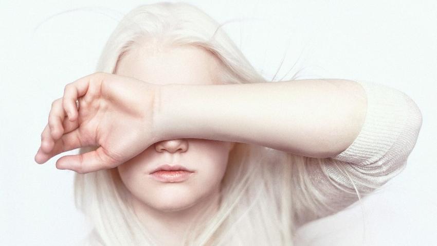 Albinismus » Ursache, Diagnose & Therapie | MeinMed.at