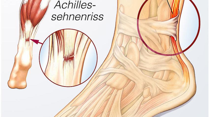 Achillessehne Bursitis Symptome – WKNPQ