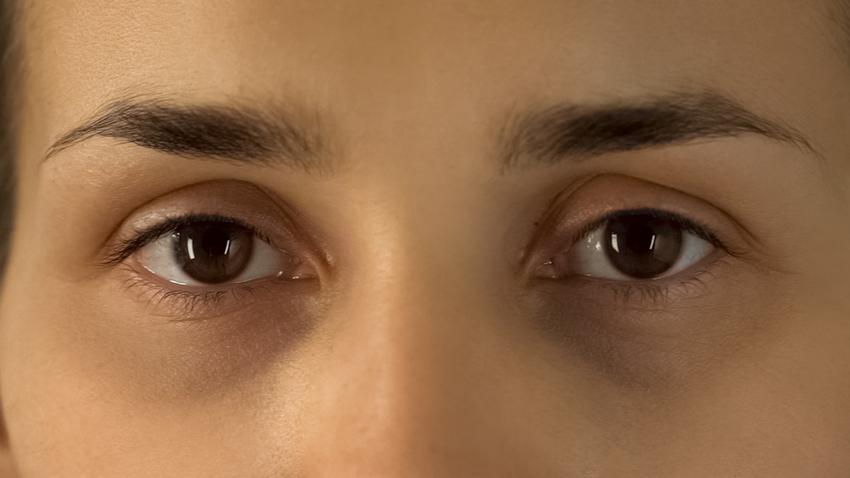 Augenringe » Ursachen wie Vitaminmangel & Behandlung | MeinMed.at