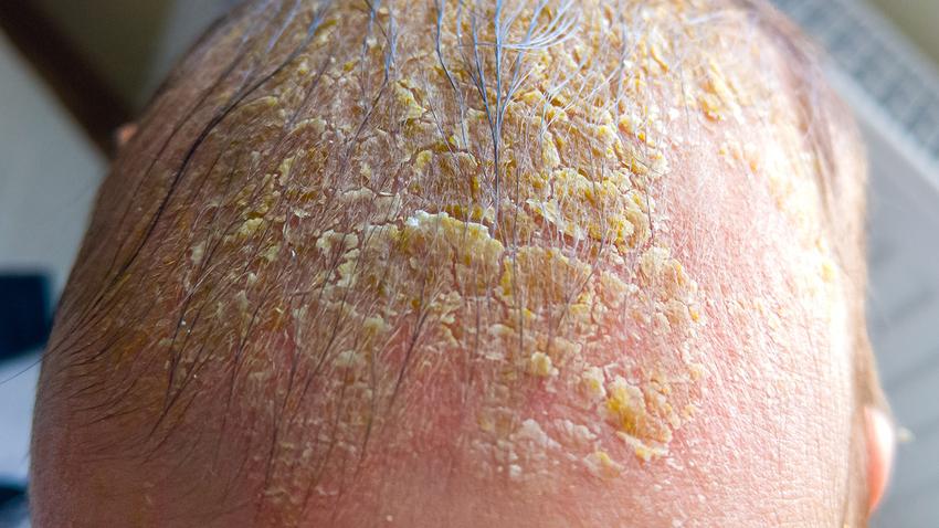 Kopfgneis » Schorf bei Babys | MeinMed.at