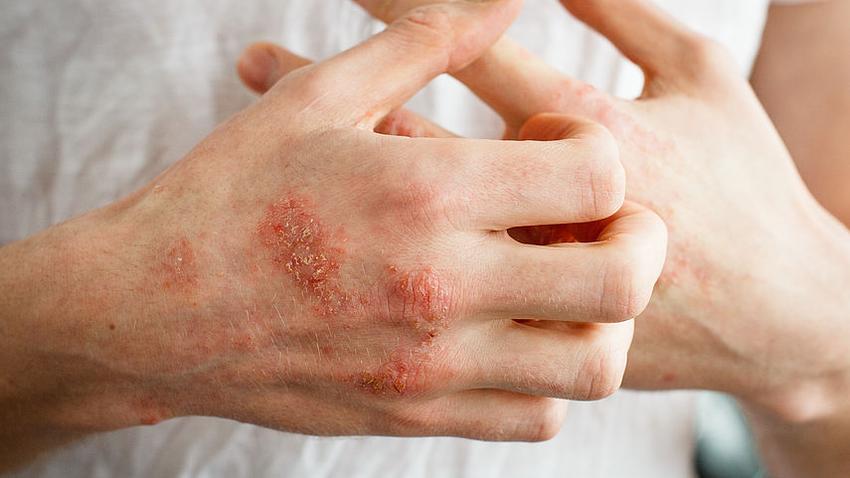 Schuppenflechte (Psoriasis) » Ursachen & Behandlung | MeinMed.at