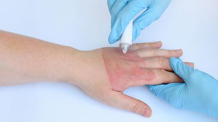 Verbrennungen » Erste Hilfe & Behandlung | MeinMed.at