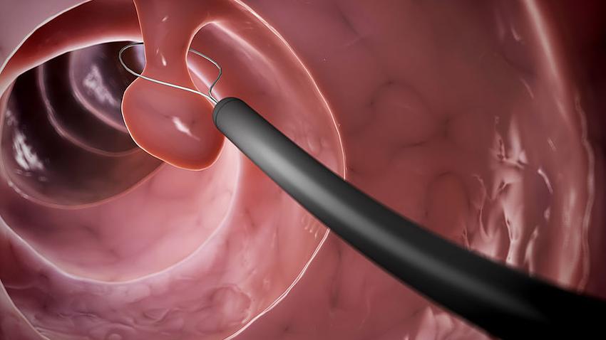 Polyp: Was sind Polypen & wie entstehen sie? | MeinMed.at