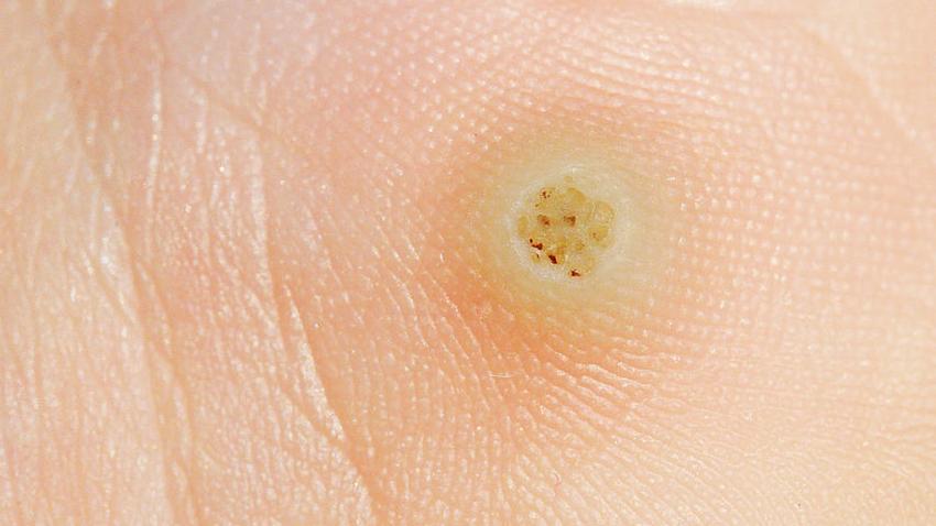 Warzen » Wie sie entstehen und wie man sie entfernt | MeinMed.at